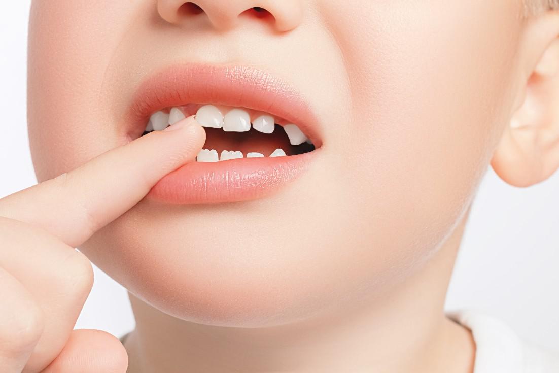 How Crooked Teeth Can Affect Your Child How Crooked Teeth Can Affect Your Child